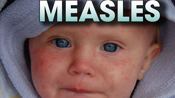 Measles Can Rob a Child's Sight - Eyecare Associates of Lee’s Summit